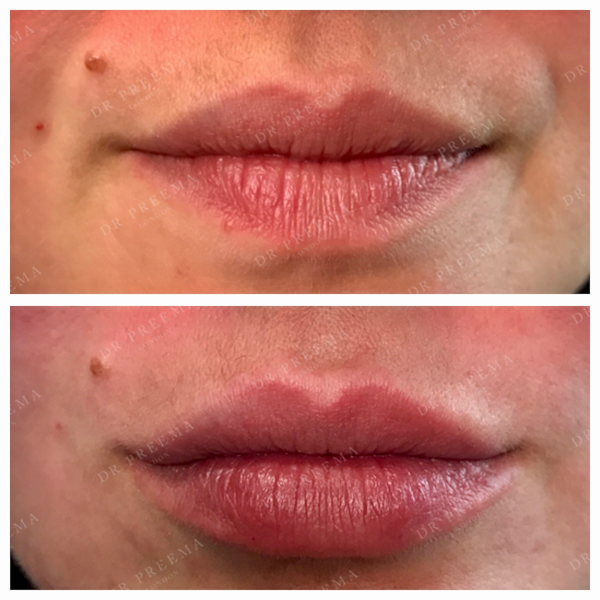 Dermal Fillers - 020 7221 0043 - Dr Preema London