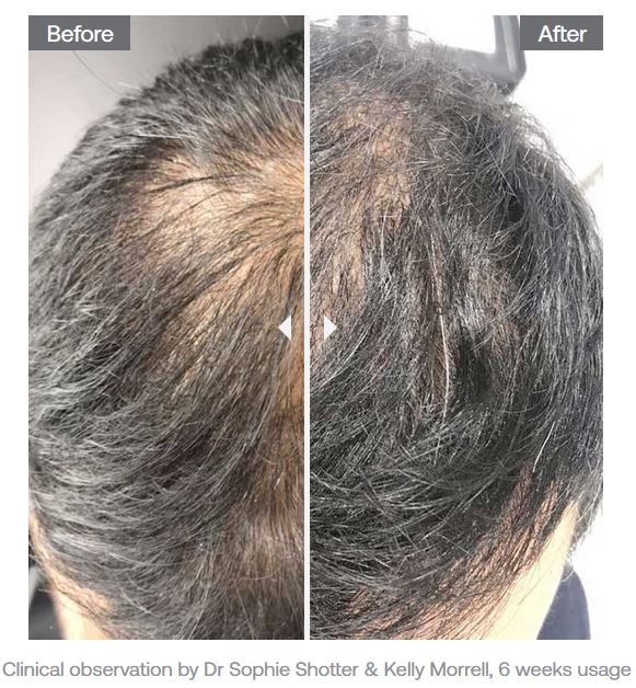 Calecim® Stem Cell Hair Treatment at Dr Preema London Clinic uses a ...