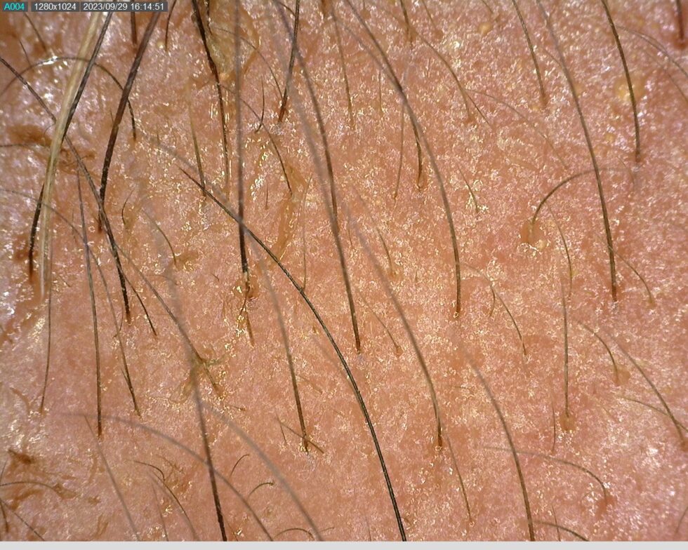 Calecim® Stem Cell Hair Treatment at Dr Preema London Clinic uses a ...